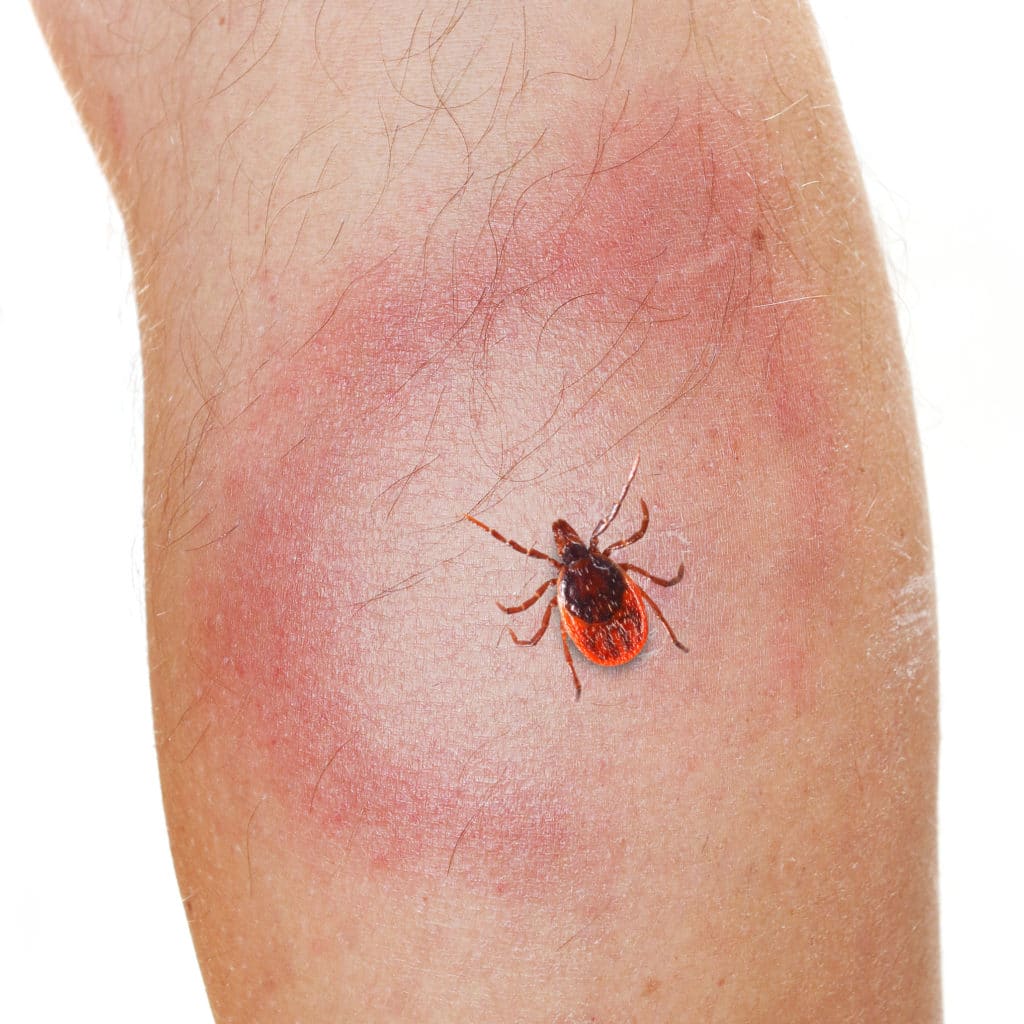Comment Évolue La Maladie De Lyme – TZXPTR