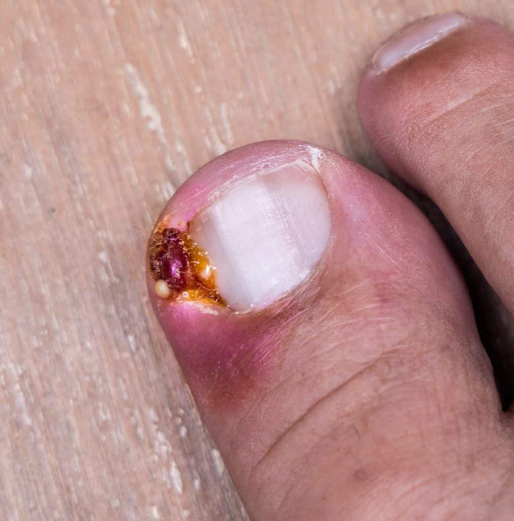 Pied diabétique (ou mal perforant plantaire) - Dr Learnycare