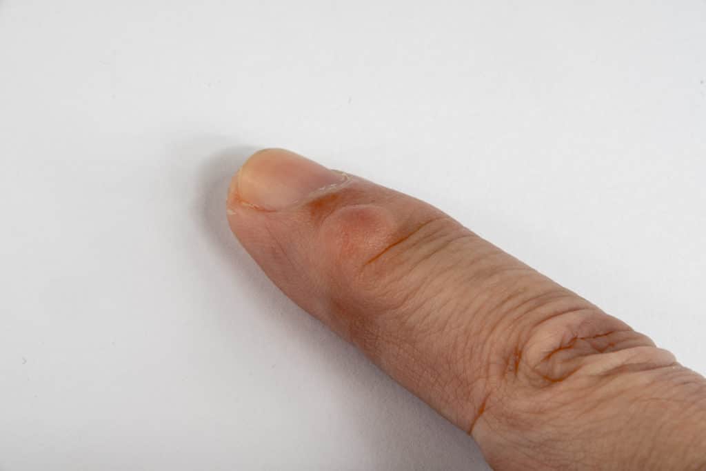 Botriomycome - Dr Learnycare