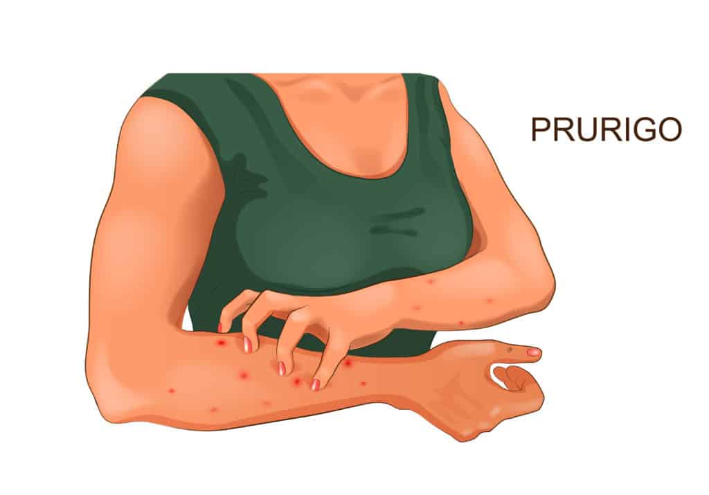 Mycose de peau sein, cuisses, aisselles (Intertrigo) - Dr Learnycare