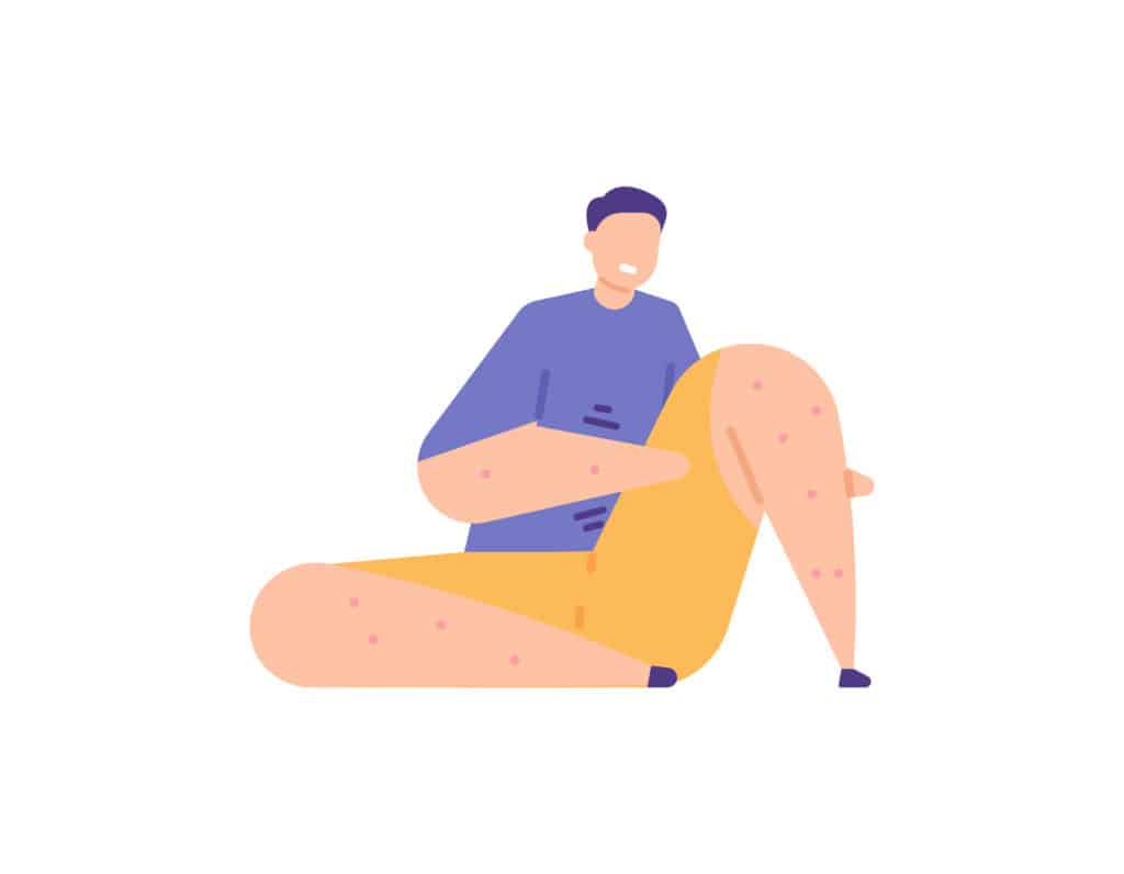 Mycose de peau sein, cuisses, aisselles (Intertrigo) - Dr Learnycare