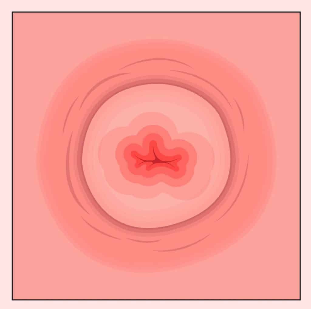 Angiodermite nécrosante - Dr Learnycare