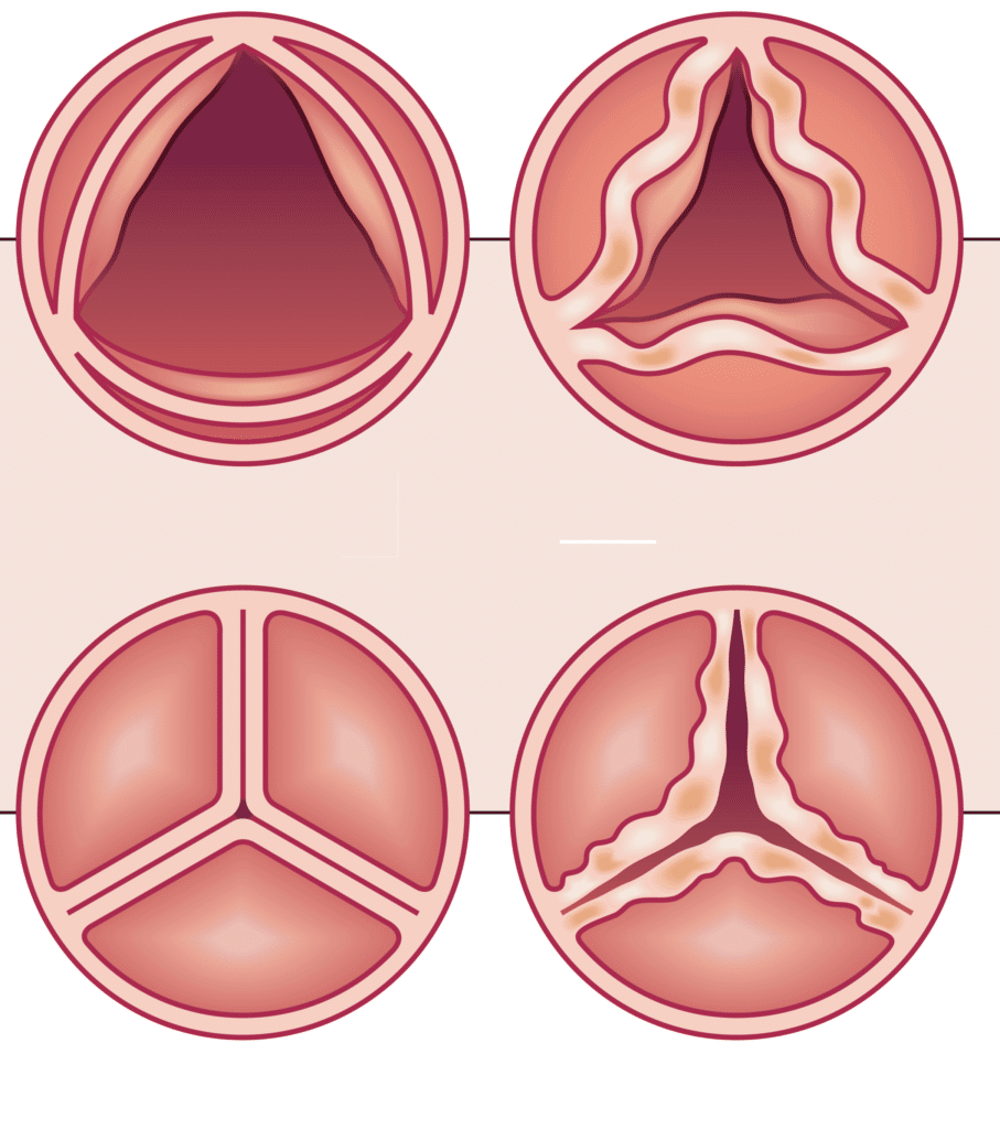 Néphroangiosclérose - Dr Learnycare