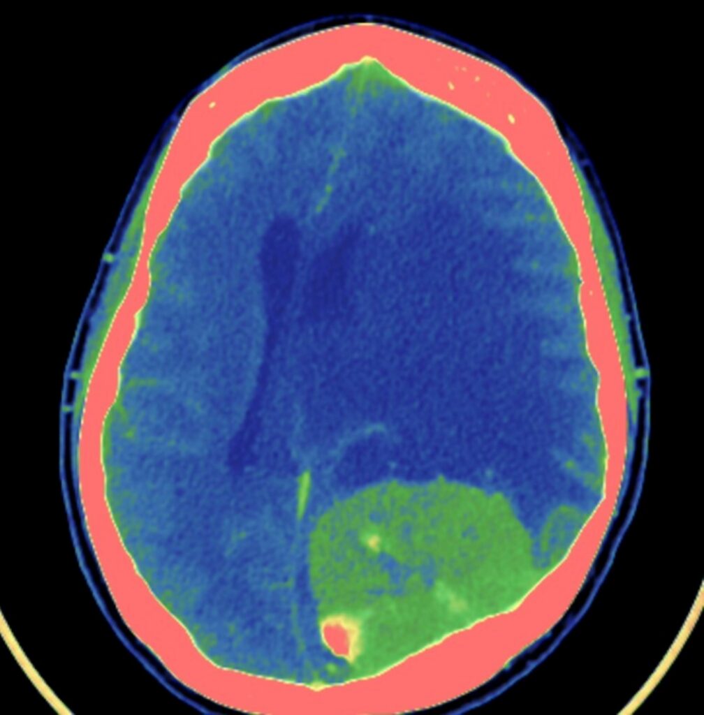 Botriomycome - Dr Learnycare